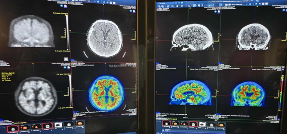 Essentia rolls out groundbreaking test for early Alzheimers detection ...