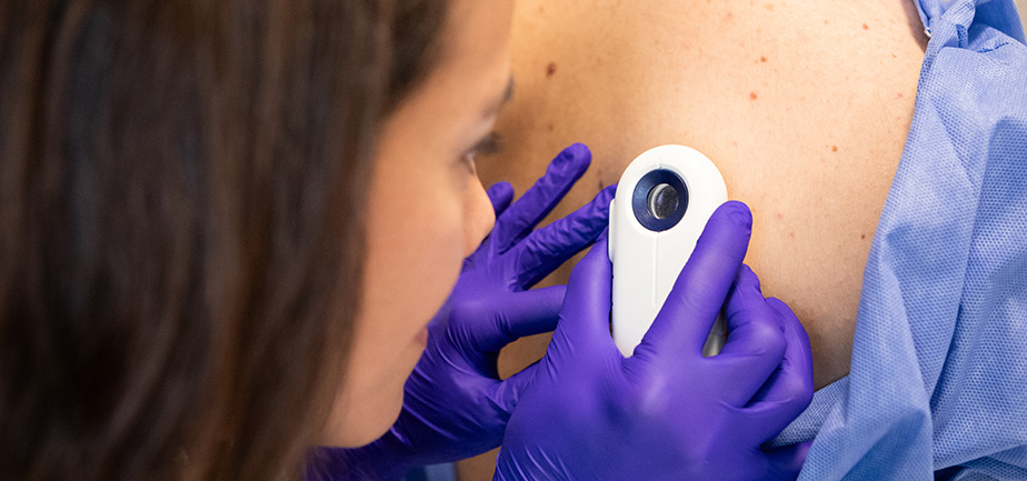 Is It a Mole or Melanoma? How to Spot the Signs of Skin Cancer ...